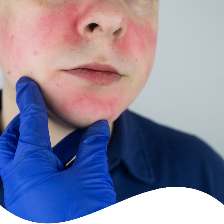 Rosacea Treatment Perth - Subi Derm