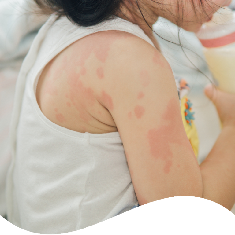 Skin Infections | Diagnosis and Treatment - Subi Derm